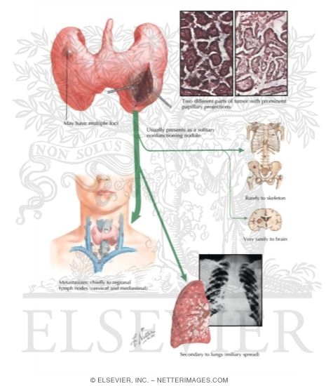 Papillary Carcinoma of the Thyroid