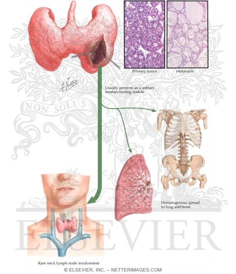Follicular Thyroid Carcinoma