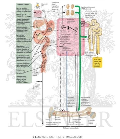 Nutritional - Deficiency Rickets and Osteomalacia