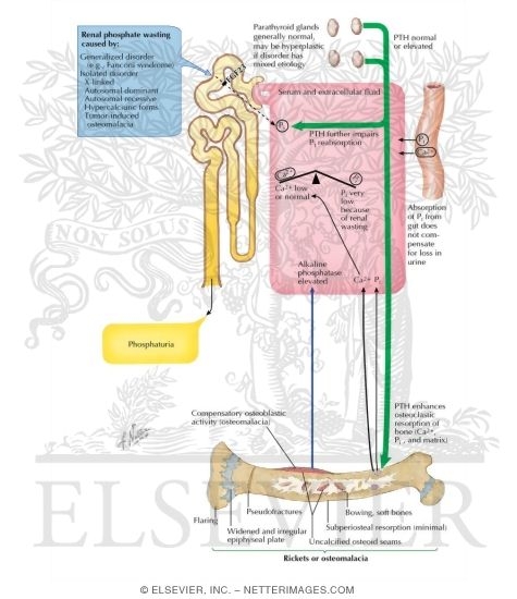 Vitamin D-Resistant Rickets and Osteomalacia Due to Proximal Renal ...