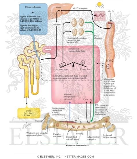 Pseudovitamin D Deficiency Rickets and Osteomalacia