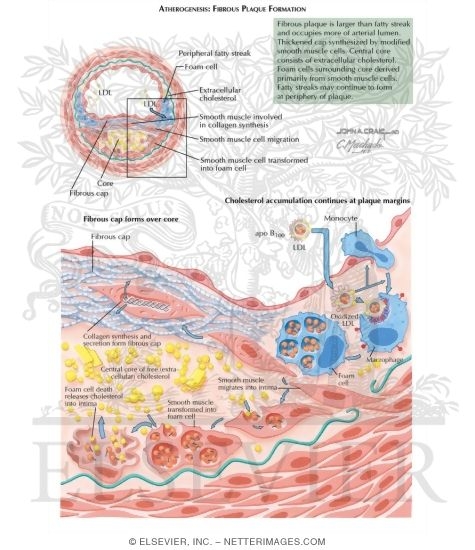 Atherosclerosis (Continued)