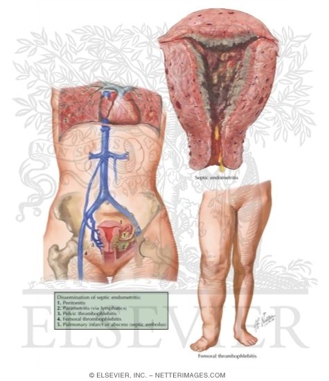 puerperal parametritis
