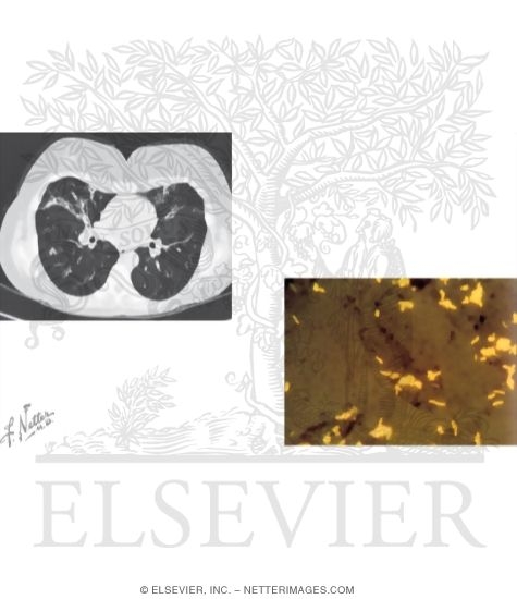 Nontuberculous Mycobacterial Lung Disease
