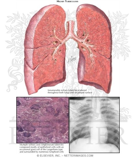 tubercle lungs