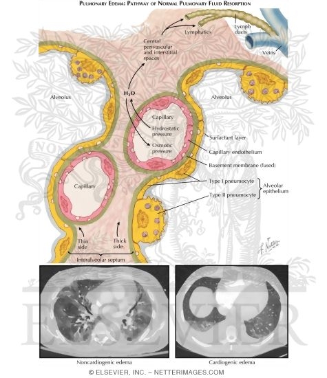 Pulmonary Edema