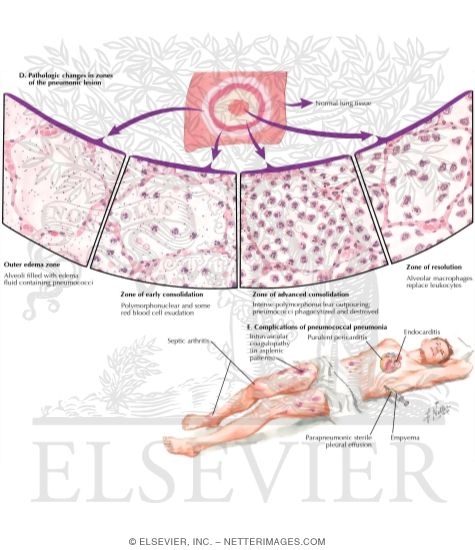 Pneumococcal Pneumonia
