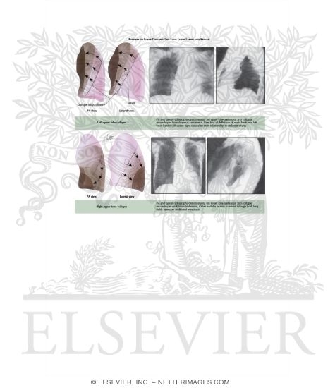 Patterns of Lobar Collapse; Left Lung (after Lubert and Krause)