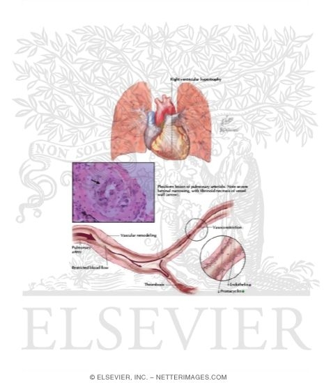 Pathology of Pulmonary Hypertension