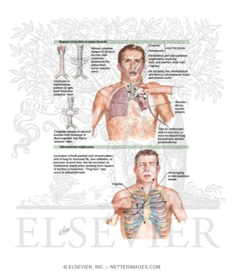 Tracheobronchial Rupture