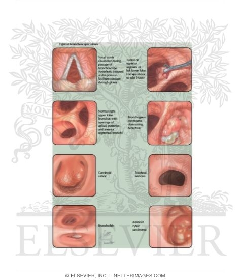 normal bronchoscopy anatomy