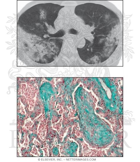 Cryptogenic Organizing Pneumonia