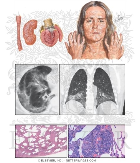 Systemic Sclerosis Scleroderma