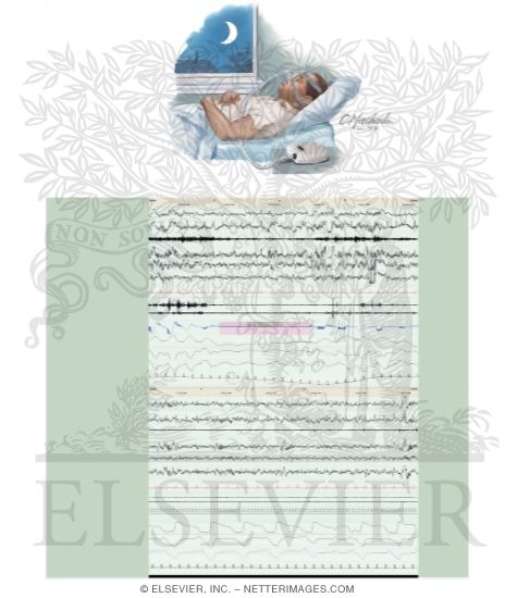 Sleep-Disordered Breathing