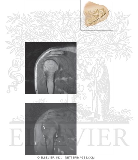 Cross Section of the Shoulder: Coronal View