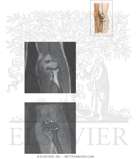 Cross Section of the Elbow: Coronal View