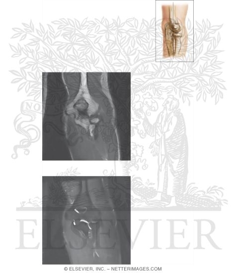 Cross Section of the Elbow: Coronal View