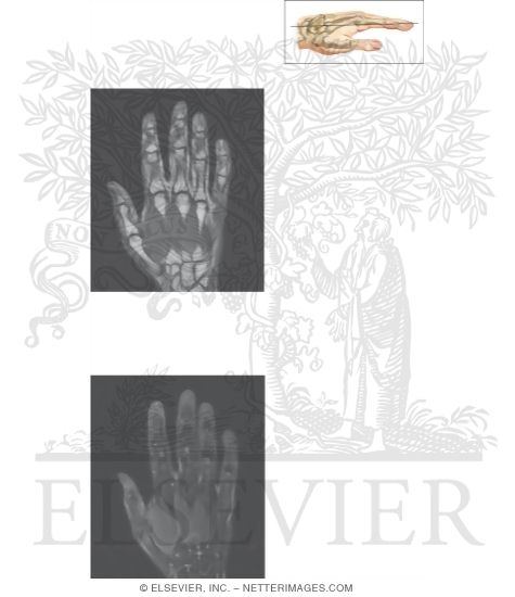 Cross Section of the Hand and Finger: Coronal View