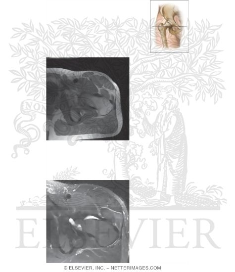 Cross Section of the Hip: Axial View