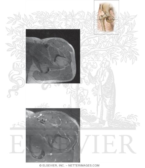 Cross Section of the Hip: Axial View