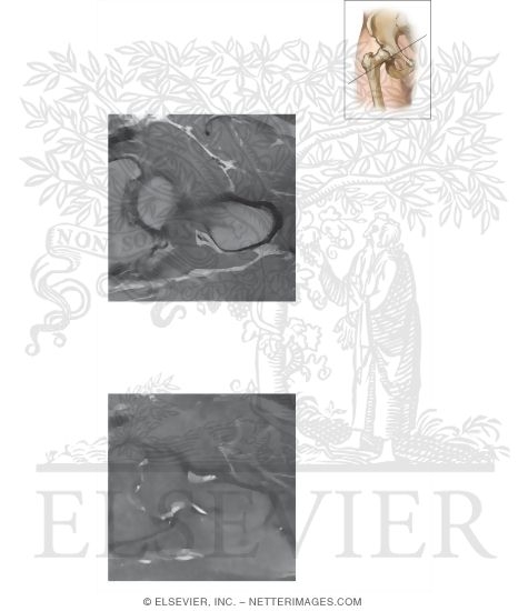 Cross Section of the Hip: Axial Oblique View