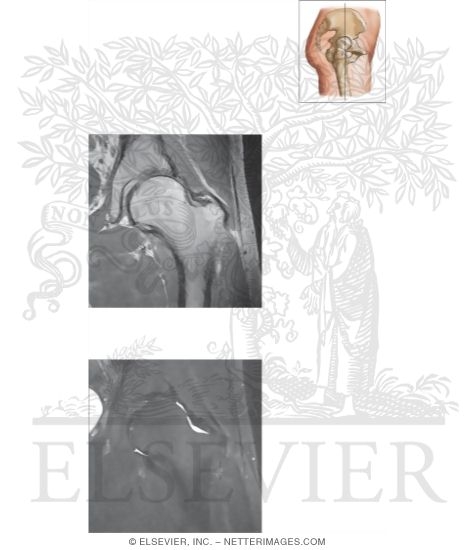 Cross Section of the Hip: Coronal View