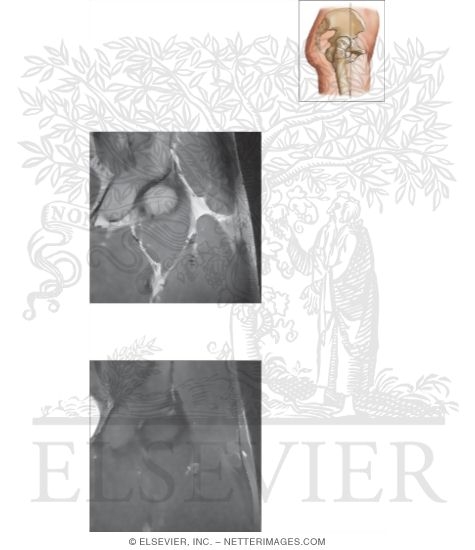 Cross Section of the Hip: Coronal View