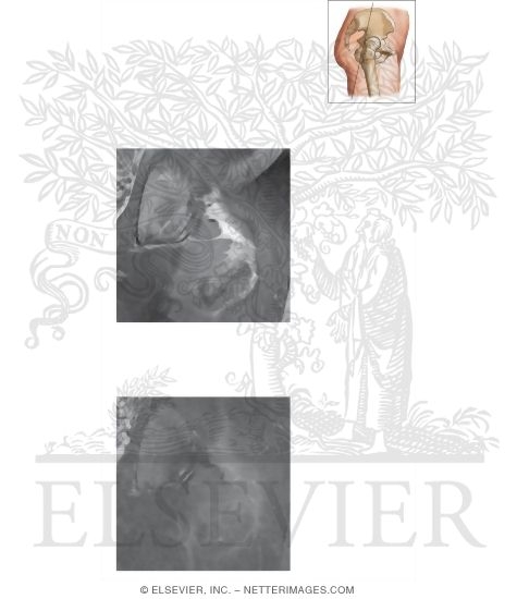 Cross Section of the Hip: Coronal Oblique View