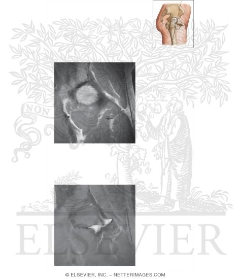 Cross Section of the Hip: Coronal Oblique View