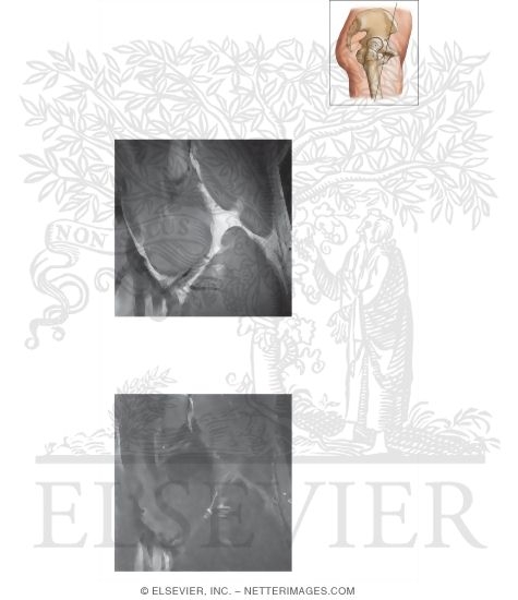Cross Section of the Hip: Coronal Oblique View