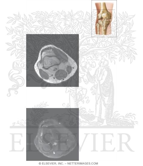 Cross Section of the Knee: Axial View