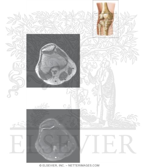 Cross Section of the Knee: Axial View