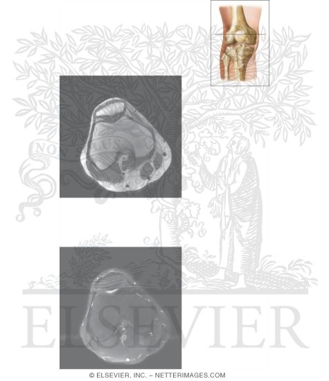 Cross Section of the Knee: Axial View