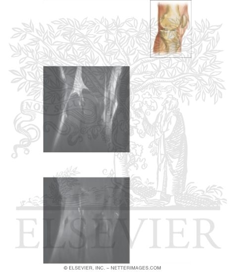 Cross Section of the Knee: Coronal View