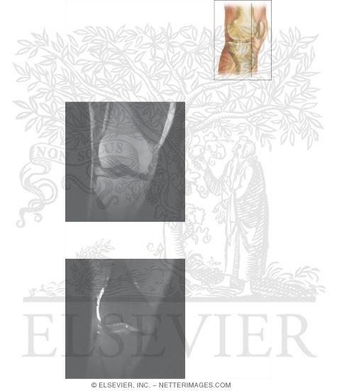 Cross Section of the Knee: Coronal View