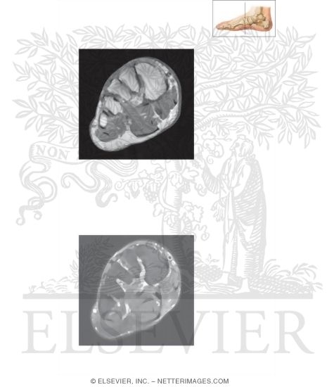 Cross Section of the Ankle and Foot: Coronal View