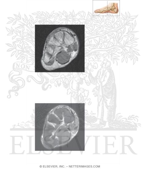 Cross Section of the Ankle and Foot: Coronal View