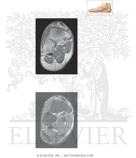 Cross Section of the Ankle and Foot: Coronal View