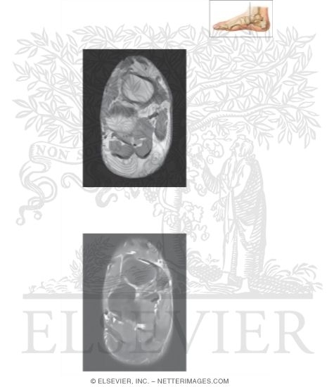 Cross Section of the Ankle and Foot: Coronal View