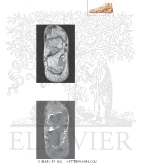 Cross Section of the Ankle and Foot: Coronal View