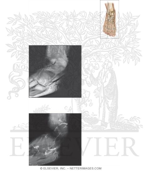 Cross Section of the Ankle and Foot: Coronal View