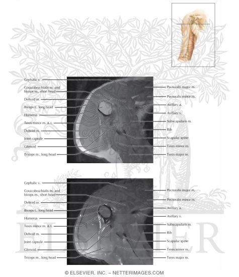 Cross Section of the Upper Arm: Axial View
