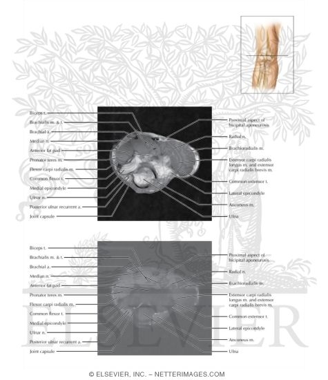Cross Section of the Elbow: Axial View