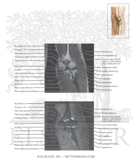 Cross Section of the Elbow: Coronal View