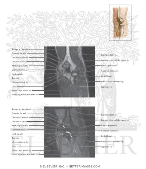 Cross Section of the Elbow: Coronal View