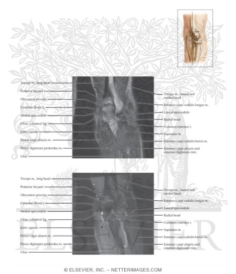 Cross Section of the Elbow: Coronal View