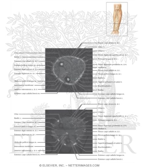 Cross Section of the Forearm: Axial View