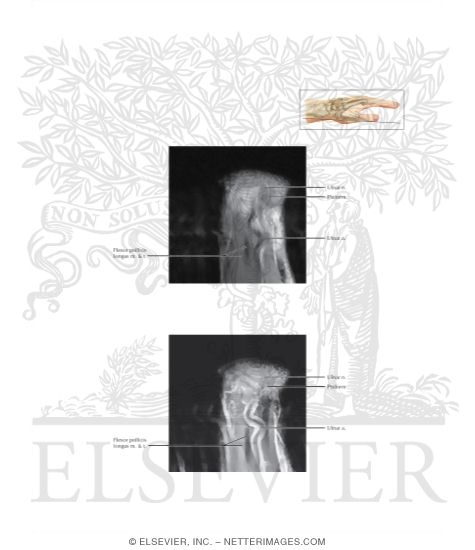 Cross Section of the Wrist: Coronal View