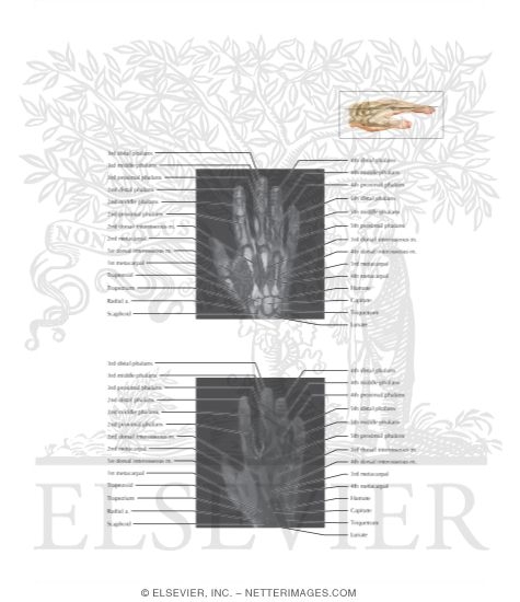 Cross Section of the Hand and Finger: Coronal View