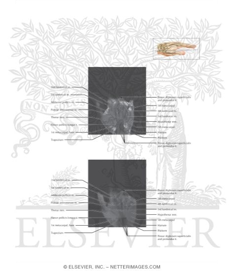 Cross Section of the Hand and Finger: Coronal View